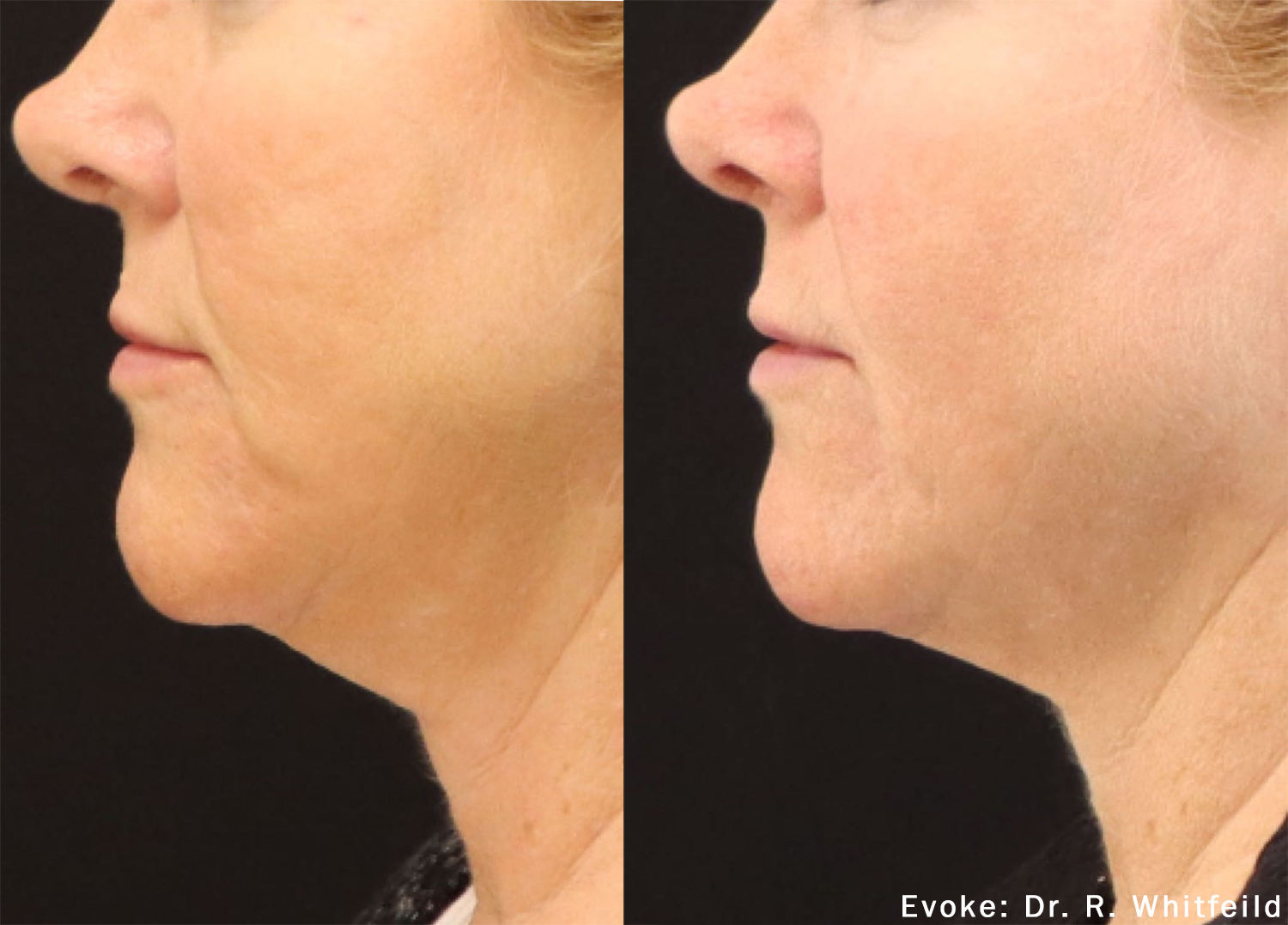 Facial Remodeling - Argyle Med Spa & Wellness Center
